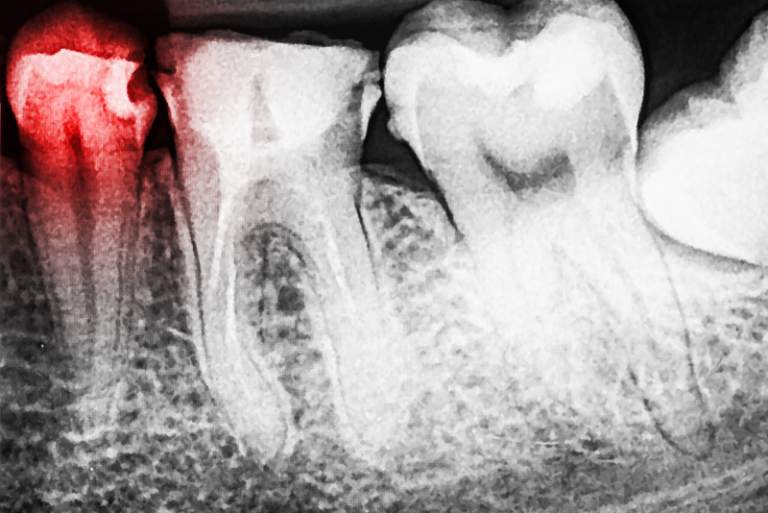 Tooth Extraction - Oral Surgery in Notting Hill | Westbourne Grove Dental